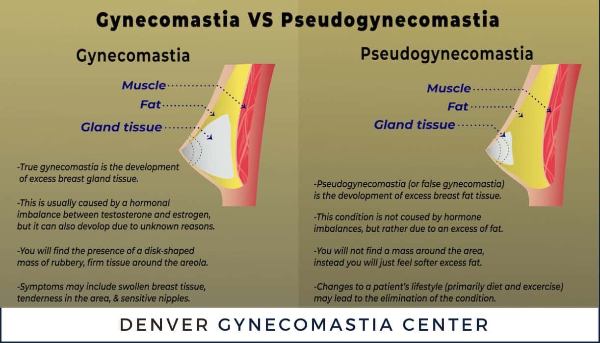 Pseudogynecomastia Surgery at the Denver Gynecomastia Center